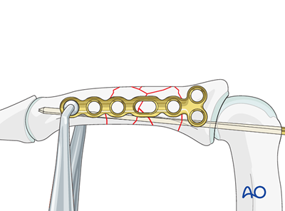 Bridge plating for Multifragmentary extraarticular or diaphyseal fracture