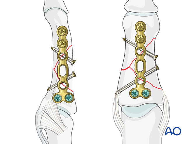 Lag-screw and plate fixation for Multifragmentary extraarticular or ...