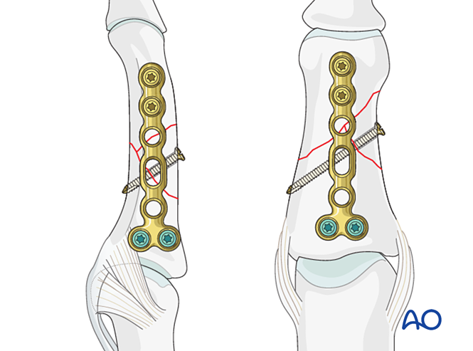 Lag-screw and plate fixation for Multifragmentary extraarticular or ...