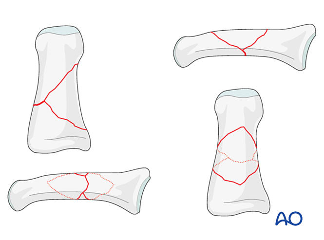 Lag-screw and plate fixation for Multifragmentary extraarticular or ...