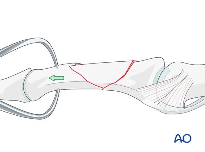 Lag-screw and plate fixation for Multifragmentary extraarticular or ...