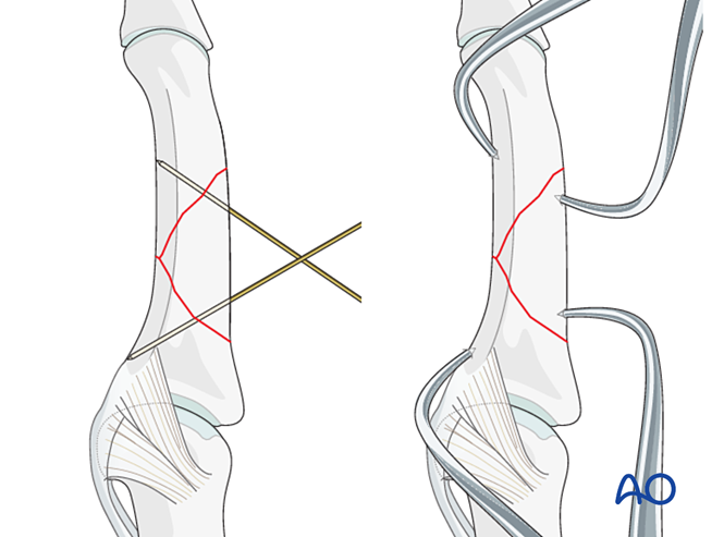 Lag-screw and plate fixation for Multifragmentary extraarticular or ...