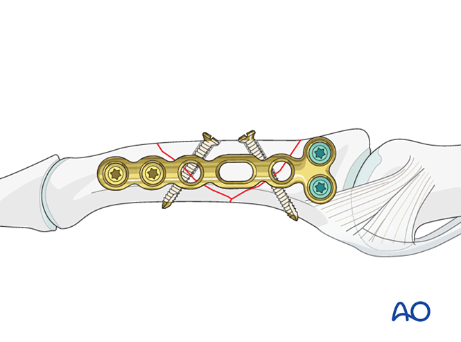 Lag-screw and plate fixation for Multifragmentary extraarticular or ...