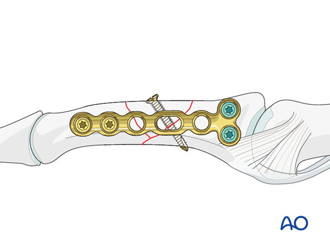 Lag-screw and plate fixation for Multifragmentary extraarticular or ...