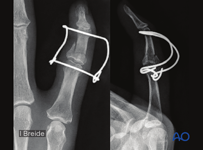 Dynamic external fixation for Multifragmentary articular fracture of ...