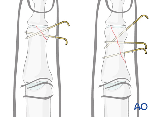 K-wire fixation for Partial articular fracture of the distal end segment