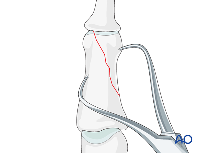 K-wire fixation for Partial articular fracture of the distal end segment