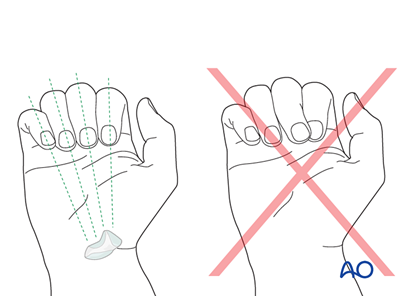 Nonoperative treatment for Dislocation of the proximal interphalangeal ...