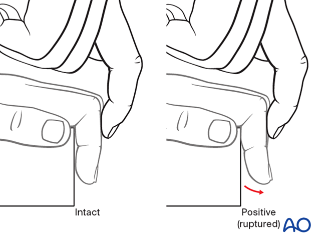 Central slip reattachment for Dorsal avulsion of the proximal end segment