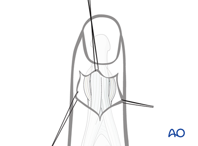 Dorsal approach to the DIP joint