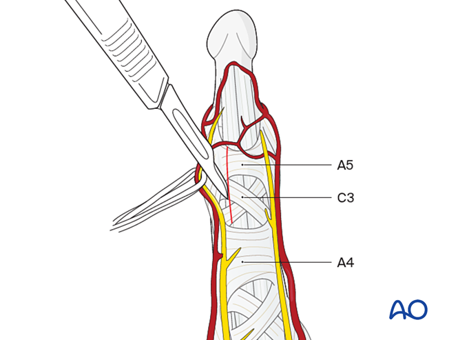 Palmar approach to the DIP joint