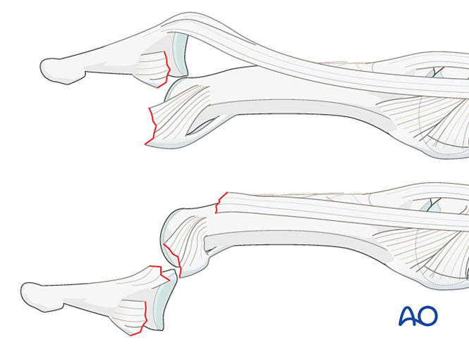 Dislocation of the distal interphalangeal joint