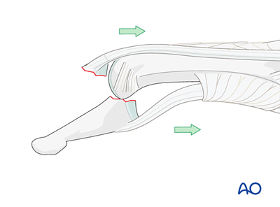 Dorsal avulsion injury of the proximal end segment (mallet finger)