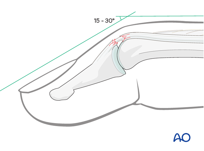 Dorsal avulsion injury of the proximal end segment (mallet finger)