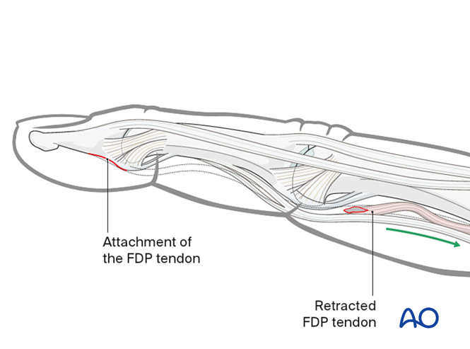 Flexor tendon mechanism