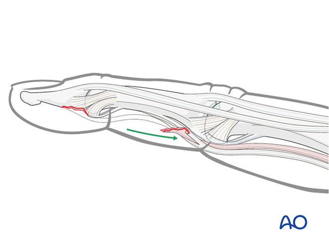 Palmar avulsion injury of the proximal end segment