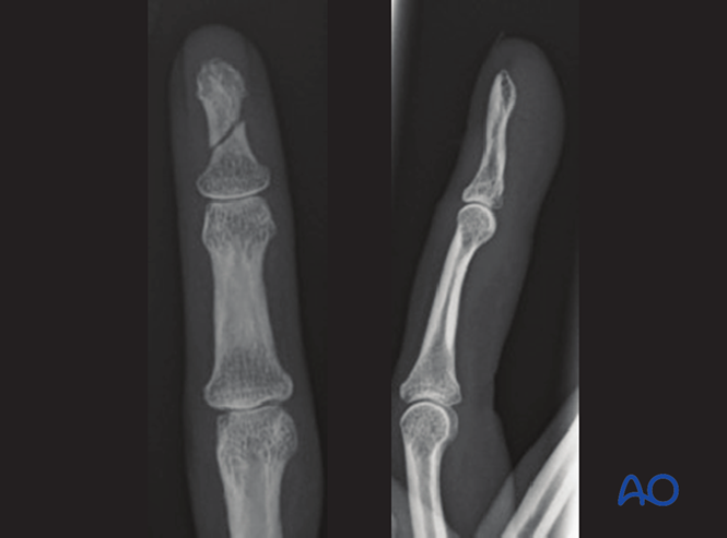 Simple fracture of the diaphysis and distal end segment