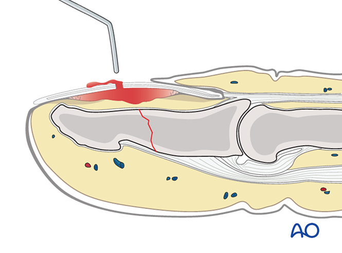 Nonoperative treatment for Simple fracture of the diaphysis and distal ...
