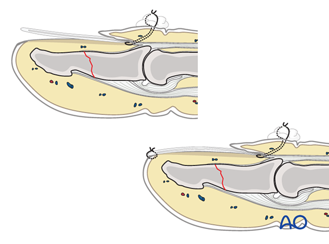Nonoperative treatment for Simple fracture of the diaphysis and distal ...