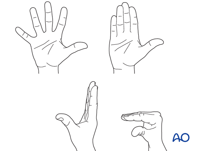 Joint transfixation with K-wire for Dorsal avulsion injury of the ...
