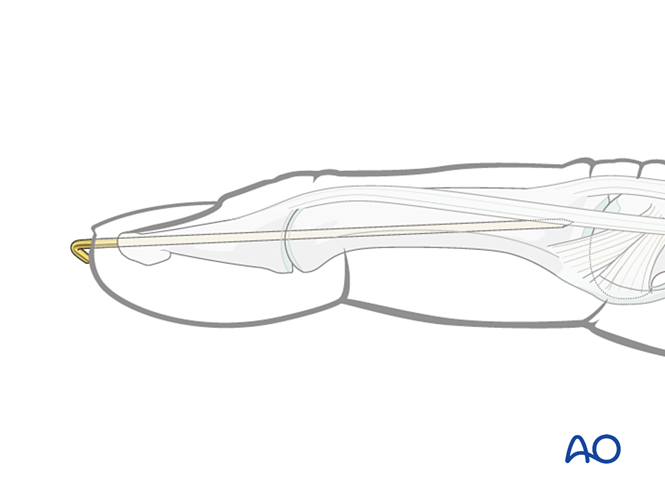 Joint transfixation with K-wire for Dislocation of the distal ...