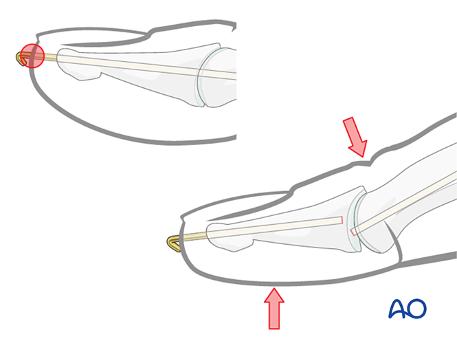 Extensor Block Pinning Or K Wire Fixation With Joint Transfixation