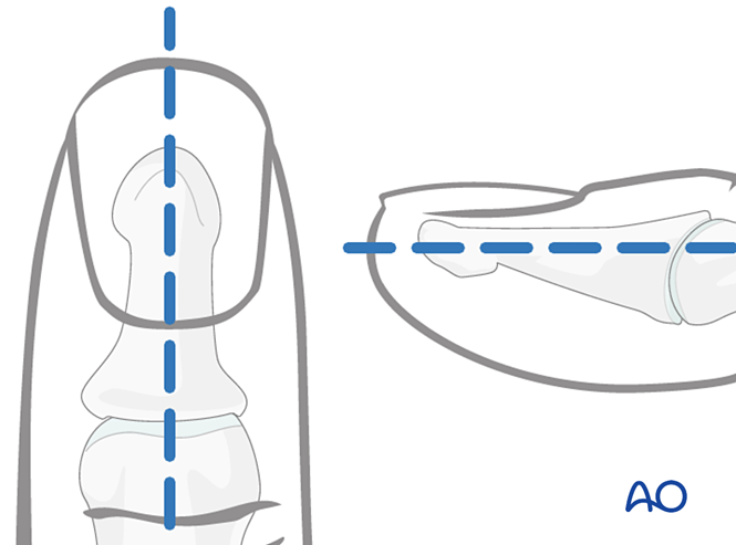 Extensor Block Pinning Or K Wire Fixation With Joint Transfixation