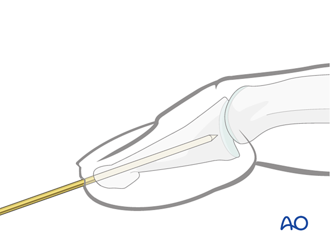 Joint transfixation with K-wire for Dislocation of the distal ...