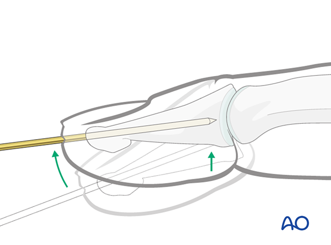 Joint transfixation with K-wire for Dislocation of the distal ...