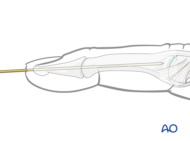 Joint transfixation with K-wire for Dislocation of the distal ...