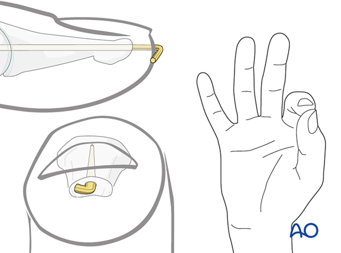 Extensor Block Pinning Or K Wire Fixation With Joint Transfixation