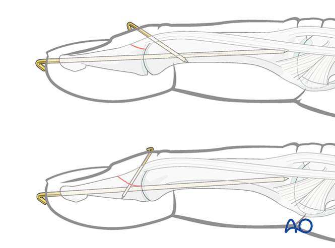 Extensor Block Pinning Or K Wire Fixation With Joint Transfixation