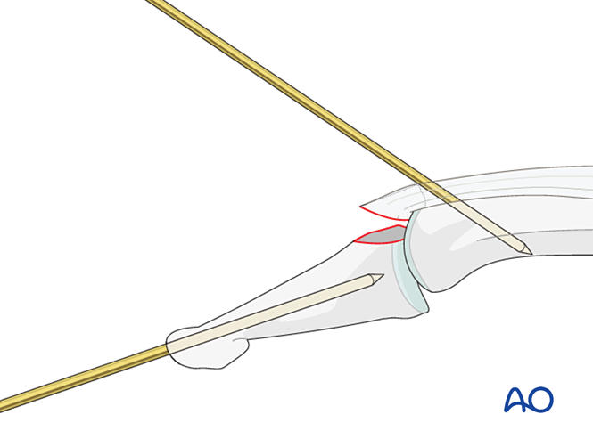 Extensor block pinning or K-wire fixation (with joint transfixation ...