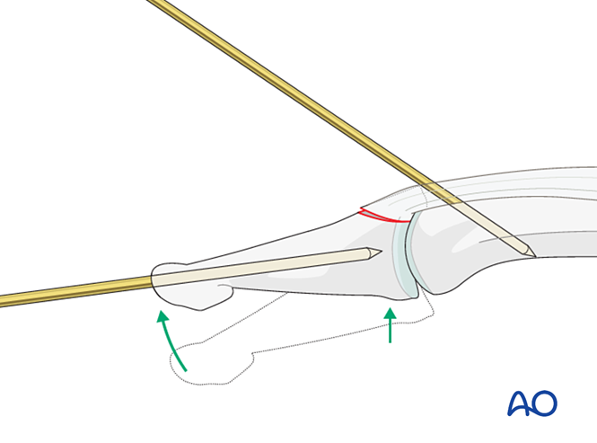 Extensor block pinning or K-wire fixation (with joint transfixation ...