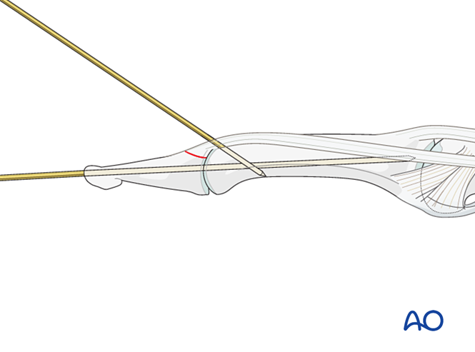 Extensor block pinning or K-wire fixation (with joint transfixation ...