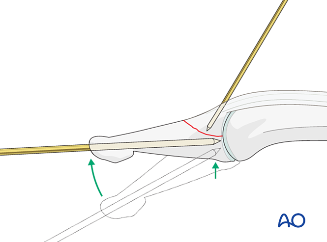 Extensor Block Pinning Or K Wire Fixation With Joint Transfixation