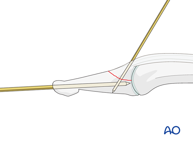 Extensor Block Pinning Or K Wire Fixation With Joint Transfixation