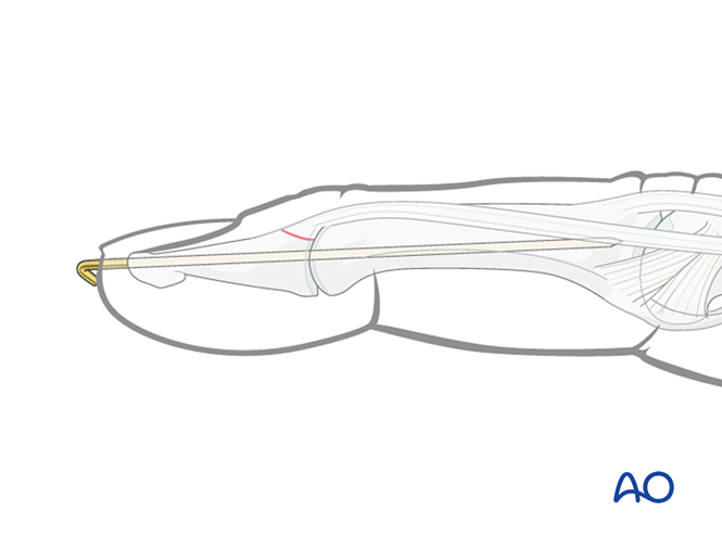 Joint transfixation with K-wire for Dorsal avulsion injury of the ...