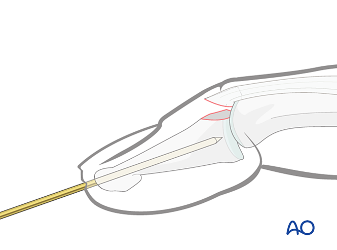 Joint transfixation with K-wire for Dorsal avulsion injury of the ...