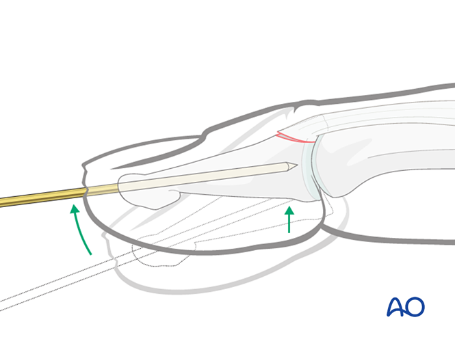 Joint transfixation with K-wire for Dorsal avulsion injury of the ...
