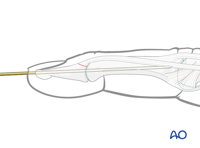 Joint transfixation with K-wire for Dorsal avulsion injury of the ...