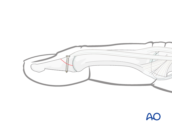 Screw fixation for Dorsal avulsion injury of the proximal end segment ...