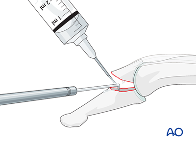Screw fixation for Dorsal avulsion injury of the proximal end segment ...
