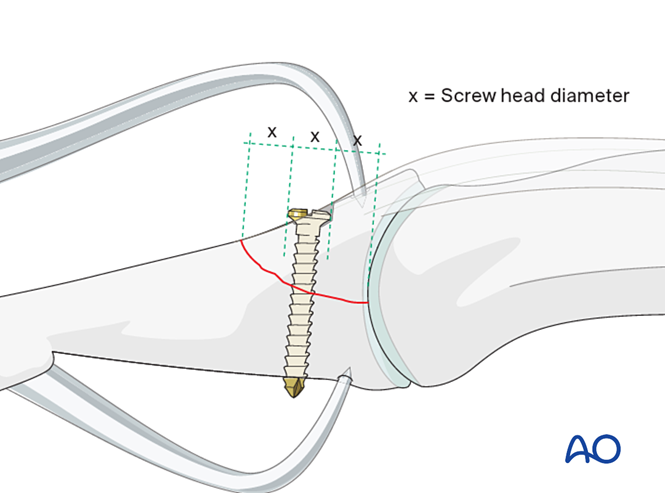 Screw fixation for Dorsal avulsion injury of the proximal end segment ...