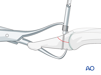 Screw fixation for Dorsal avulsion injury of the proximal end segment ...