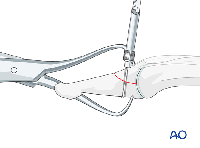 Screw fixation for Dorsal avulsion injury of the proximal end segment ...
