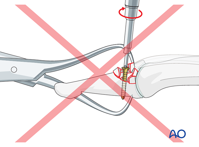 Screw fixation for Dorsal avulsion injury of the proximal end segment ...