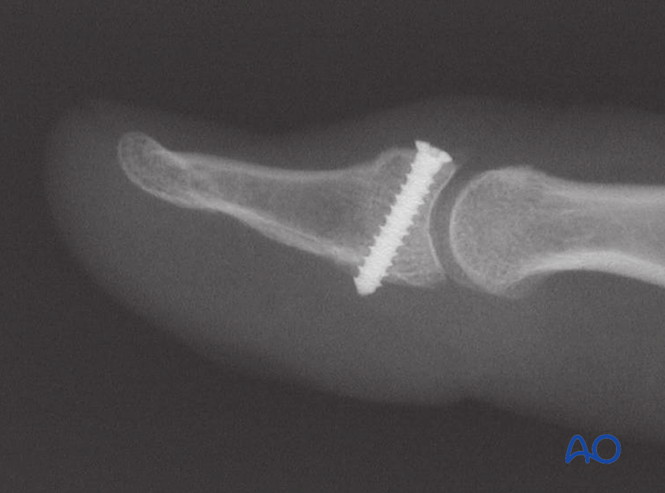Screw fixation for Dorsal avulsion injury of the proximal end segment ...