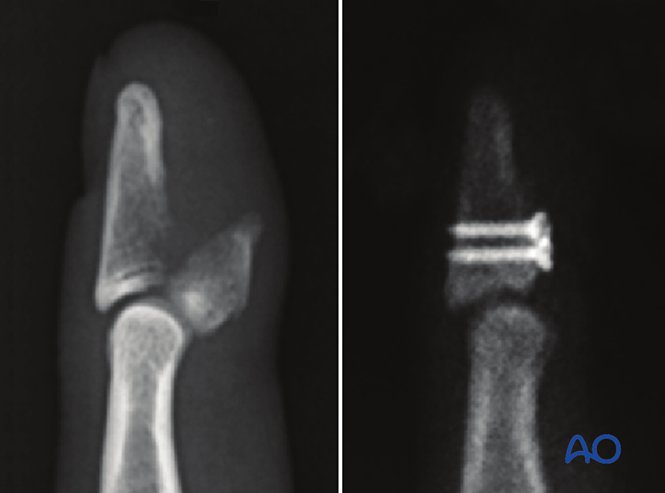 Screw fixation for Palmar avulsion injury of the proximal end segment