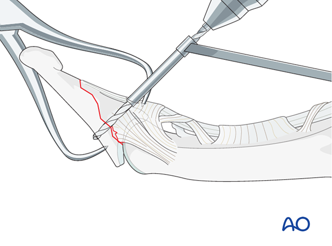Screw fixation for Palmar avulsion injury of the proximal end segment